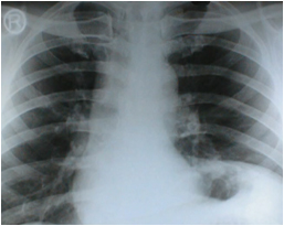 Eventration_Diaphragm – Laparoscopic, thoracoscopic and hernia surgery
